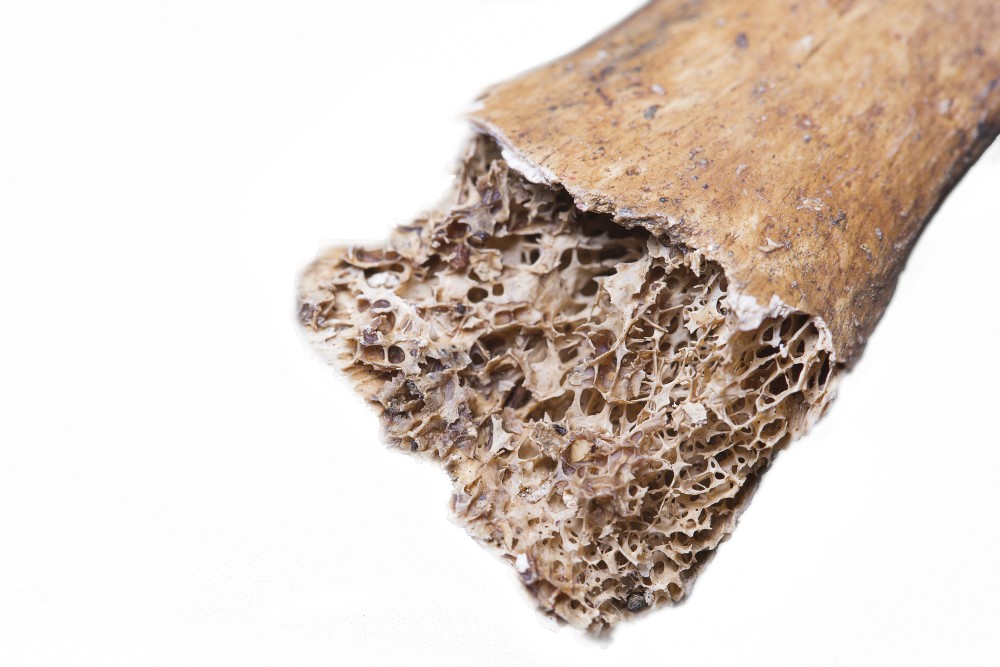 5 Myths About Bone Loss Debunked