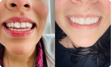Ortodoncia Invisible: alinea tus dientes sin brackets | moons